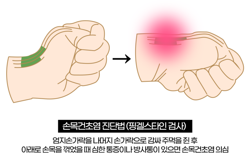 엄지손가락 통증 질환 손목건초염드퀘르벵 · 방아쇠수지 증후군 네이버 블로그