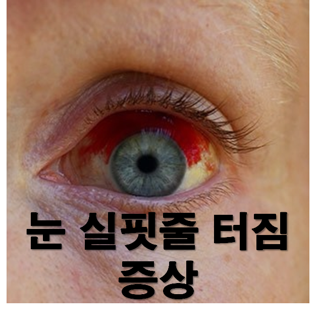 눈 실핏줄 터짐 ‘결막하 출혈 증상의 원인과 치료방법 네이버 블로그