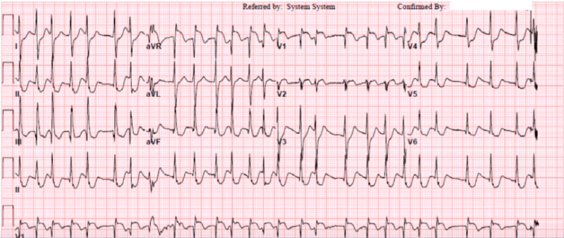 [심전도] STE in aVR...DDx : 네이버 블로그