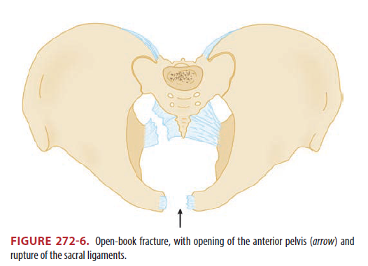 오토바이 TA에 의한 pelvic bone fracture (open-book) 그리고 소고 : 네이버 블로그