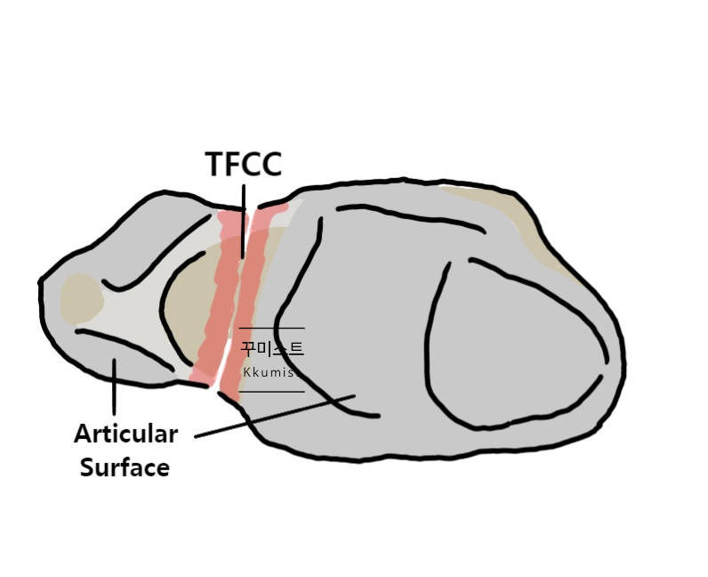 새끼손가락 및 손목 통증 삼각섬유연골복합체(TFCC) 손상과 증상 그리고 스페셜테스트 : 네이버 블로그