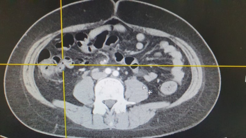 CT로 appendix 찾아보기 : 네이버 블로그