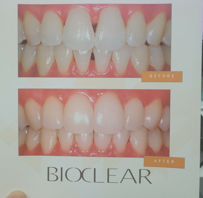 BIOCLEAR matrix system - Anterior matrix kit (바이오클리어 매트릭스) : 네이버 블로그