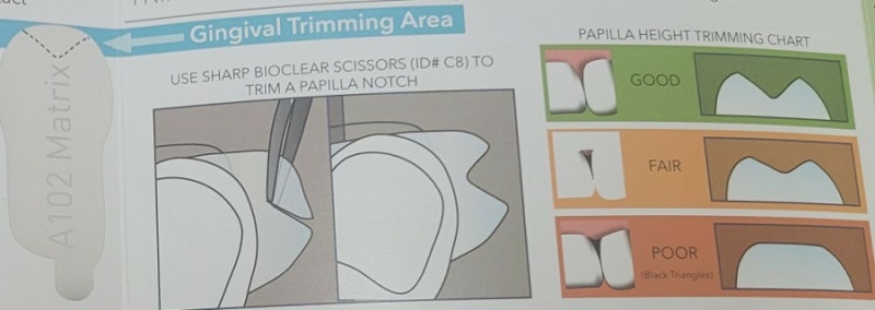 BIOCLEAR matrix system - Anterior matrix kit (바이오클리어 매트릭스) : 네이버 블로그