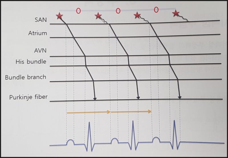 동방 차단 (SinoAtrial block ; SA block) : 네이버 블로그