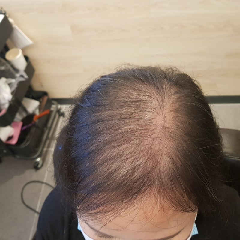 머리숱 없는 40대 여자 헤어증모 후 정수리탈모 커버 네이버 블로그
