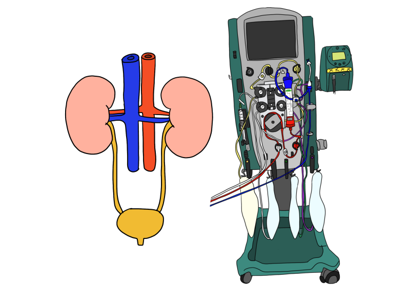쉽게 이해하는 CRRT(Continuous Renal Replacement Therapy) : 네이버 블로그