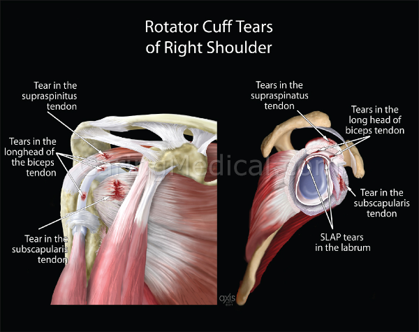 Shoulder A/S Subscap repair(Ssc repair) : 네이버 블로그