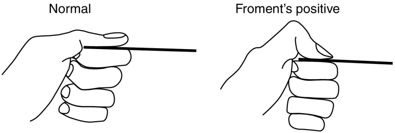 새끼손가락 저림, 3가지 원인과 치료 : 네이버 블로그