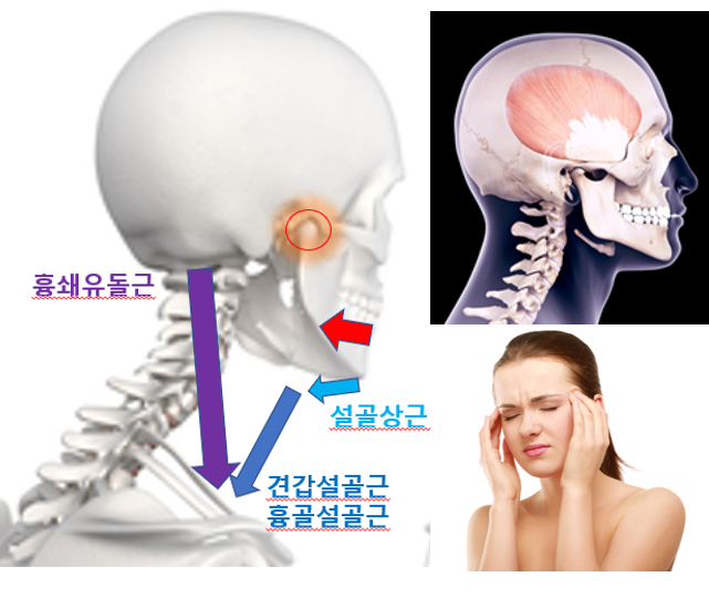 두통의 원인이 거북목에 있다구요 두통치료 천안아산 달천한의원 네이버 블로그