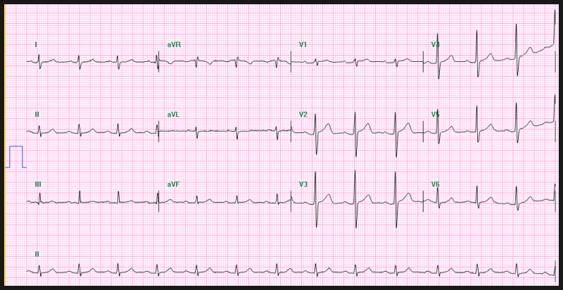 방실결절회귀성빈맥 (atrioventricular node reentry tachycardia, AVNRT) : 네이버 블로그