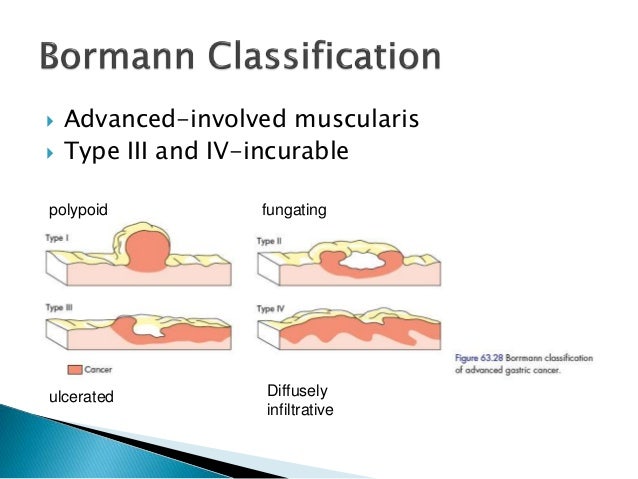 진행 위암의 정의와 분류(Advanced Gastric Cancer: An Overview and classification ...