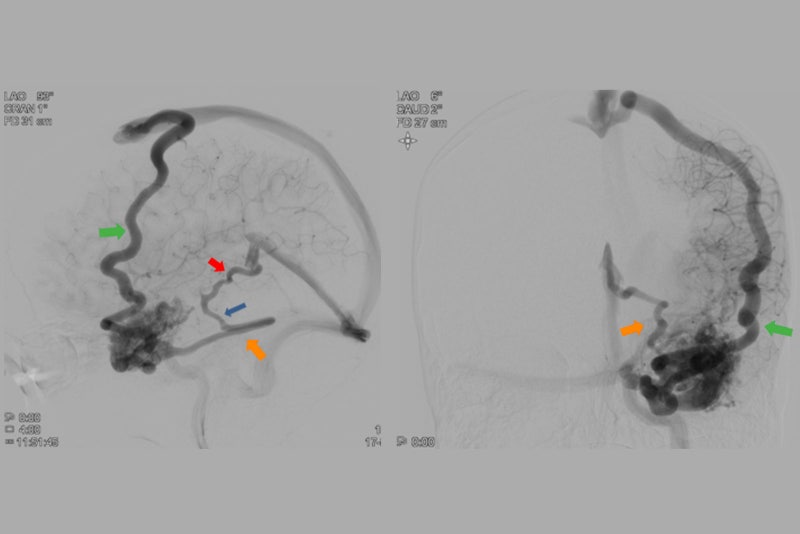 동정맥 기형(AVM; Arteriovenous Malformation) 치료에서 형광(Fluorescence) 기능 ...