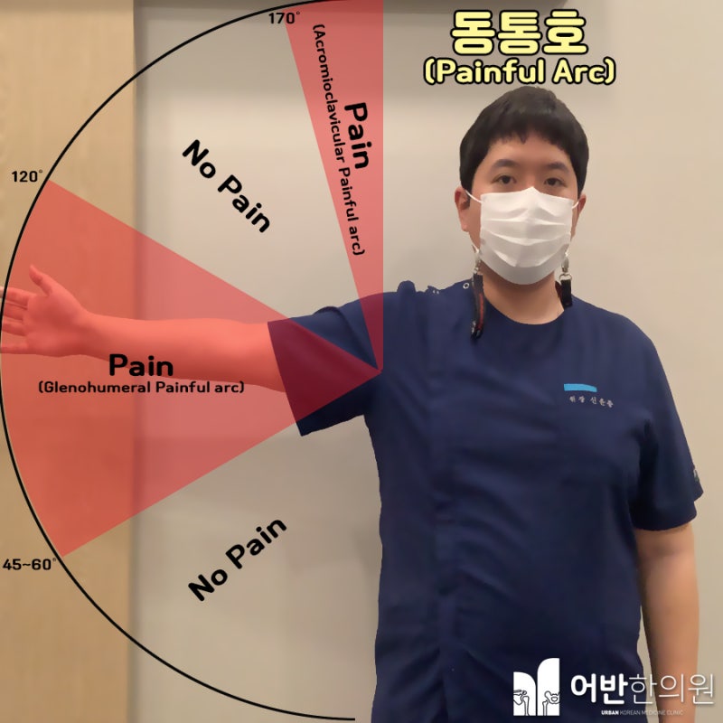 어깨 통증 검사 받아보니 어깨 충돌 증후군 네이버 블로그