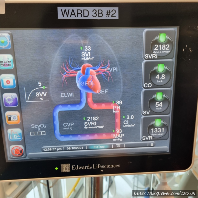 [싱가폴 중환자실 간호사] FloTrac monitoring : 네이버 블로그