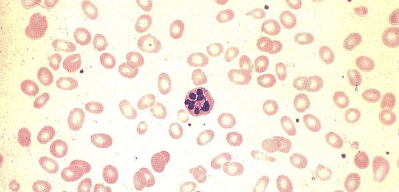 [혈액] 거대적아구성빈혈(Macrocytic anemia) : 네이버 블로그