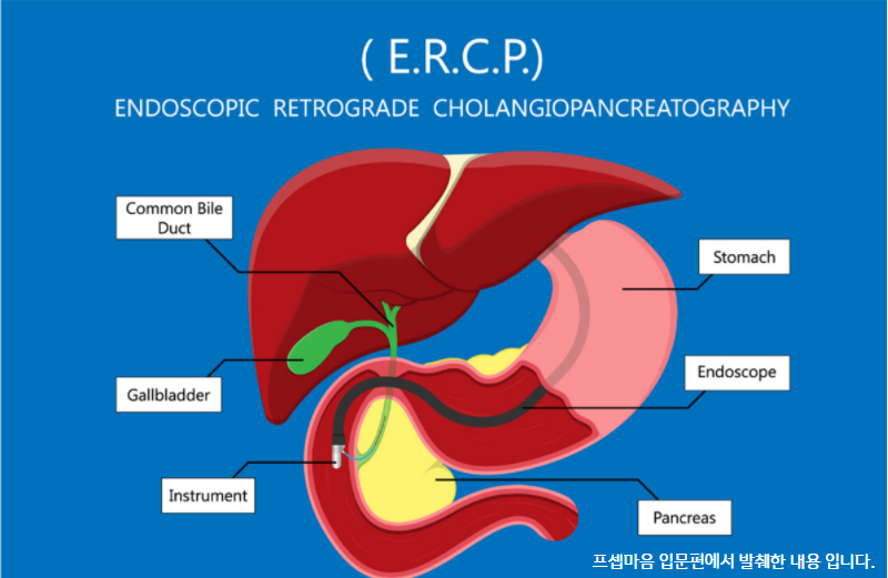 의학용어 ERCP 적응증, 준비사항, 주의할 점 : 네이버 블로그