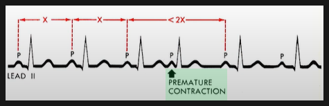 APC (심방조기수축) 와 non-conducted APC (전도되지 못한 심방조기수축) : 네이버 블로그