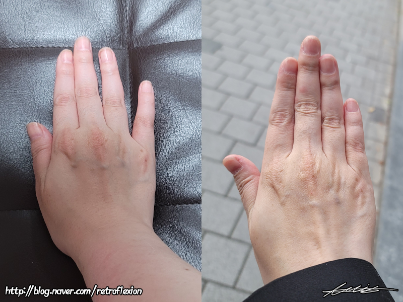 팔꿈치터널증후군주관증후군 수술 후기 네이버 블로그