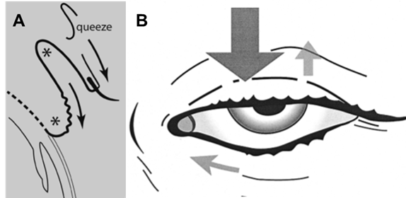 [EYE잘보여] 상윤부각결막염(Superior Limbic Keratoconjunctivitis; SLK) - 정의, 발병기전 ...