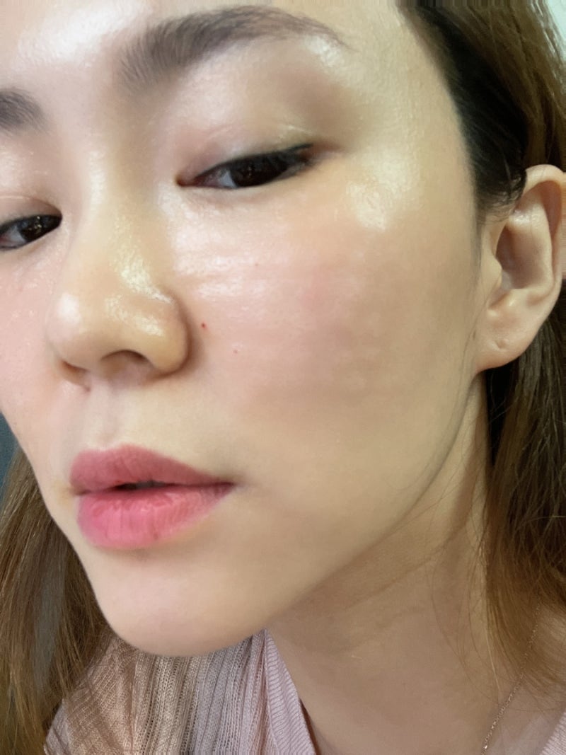리쥬란힐러 Hb 플러스 후기 안아프다며ㅠㅠㅠㅠ혐짤주의 통증효과 네이버 블로그