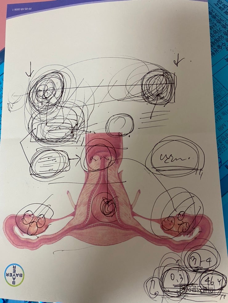 자궁내막증식증 원인 진단 치료 네이버 블로그