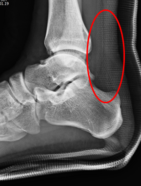 발목에서 뚝 소리가 났어요 ㅠㅠ - 아킬레스건 파열 : 네이버 블로그