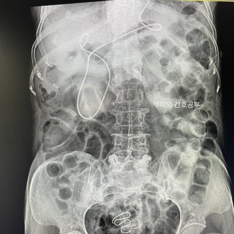 쭈이와 간호공부:) ERCP 그리고 ENBD : 네이버 블로그