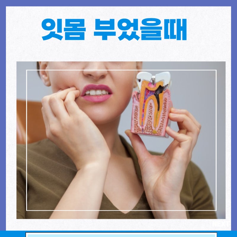 잇몸 부었을때 잇몸염증 치은염 증상 치주염증상 치주질환 네이버 블로그