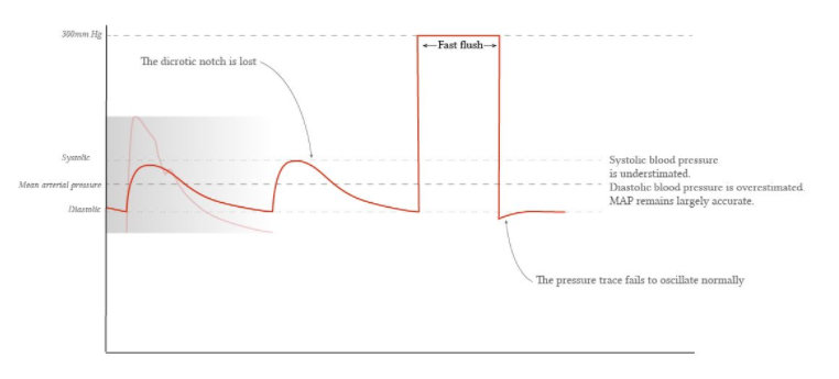a-line(arterial line)의 모든 것(2)- square wave test, overdamping ...