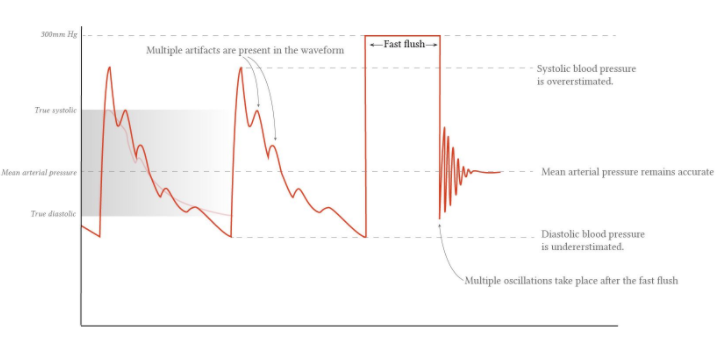 a-line(arterial line)의 모든 것(2)- square wave test, overdamping ...