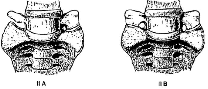 [요추] lumbosacral transitional vertebrae, Sacralization, Lumbarization ...