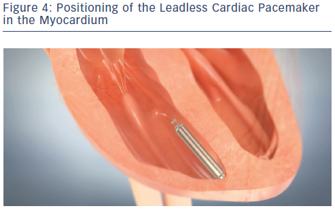 014. 신규간호사를 위한 pacemaker의 모든 것 : 네이버 블로그