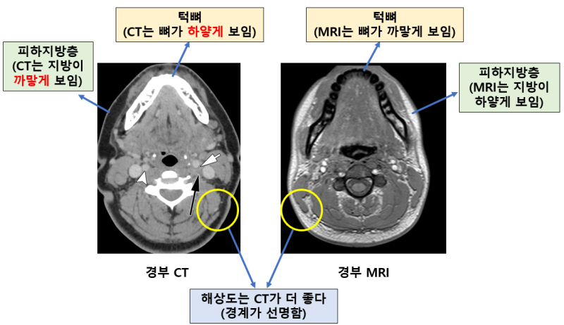 Ct 와 Mri 무엇이 더 정확한 검사일까featct와 Mri 구분법 네이버 블로그