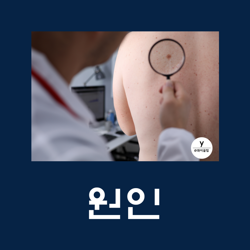 몸에 빨간점 피부 붉은반점 원인 10가지 체리혈관종 간경화 점상출혈일수도~ 네이버 블로그