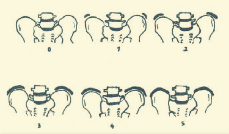 척추측만증 상태를 보기 위한 리서사인 (Risser sign) : 네이버 블로그