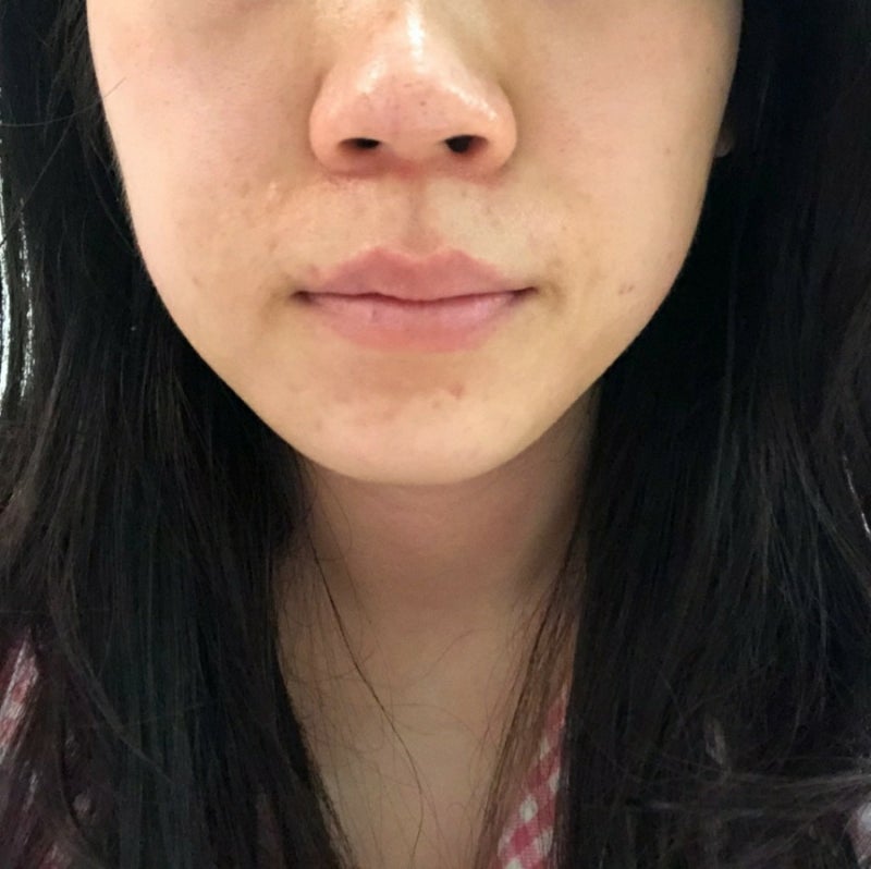 삼성동피부과 엑셀v레이저 여드름 자국 붉은기 극복기 네이버 블로그