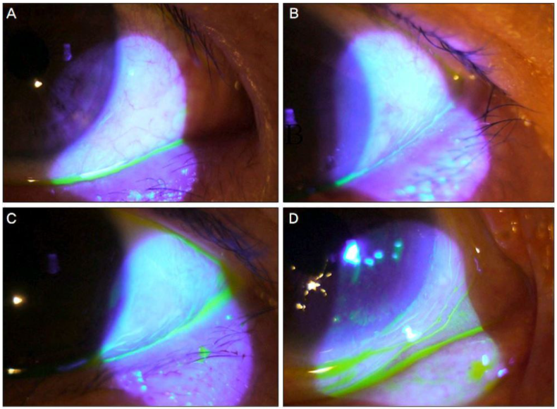 [EYE잘보여] 결막이완증(Conjunctivochalasis); 결막늘어짐, 결막주름, 늘어진 흰동자 - 원인, 증상, 진단 ...