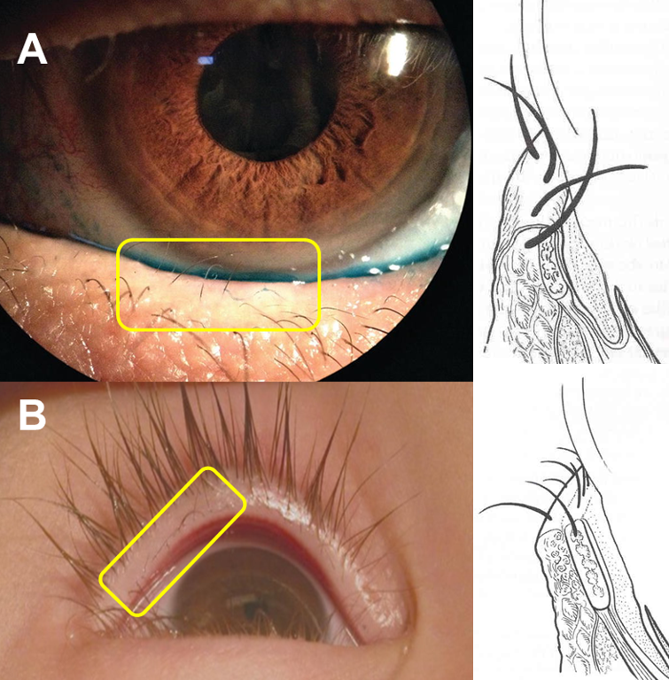 [EYE잘보여] 속눈썹증(Trichiasis, 첩모난생) vs. 두줄속눈썹(Distichiasis, 첩모중생) - 원인, 발병 ...