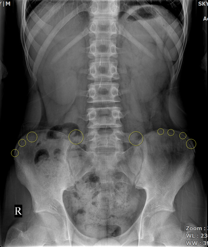 척추측만증 상태를 보기 위한 리서사인 (Risser sign) : 네이버 블로그