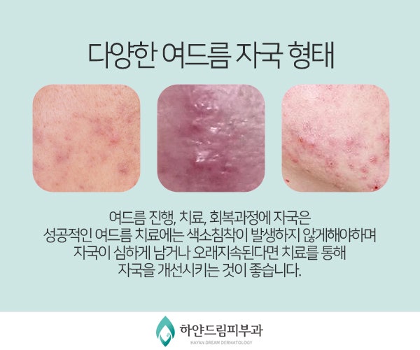 붉은 여드름 자국 깨끗하게 없애는 방법 네이버 블로그