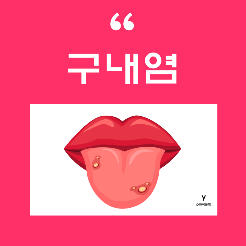 구내염 빨리낫는법 입안 헐었을때 원인 증상 약 알보칠 연고 가글 염증 칸디다 아프타성 궤양성 네이버 블로그