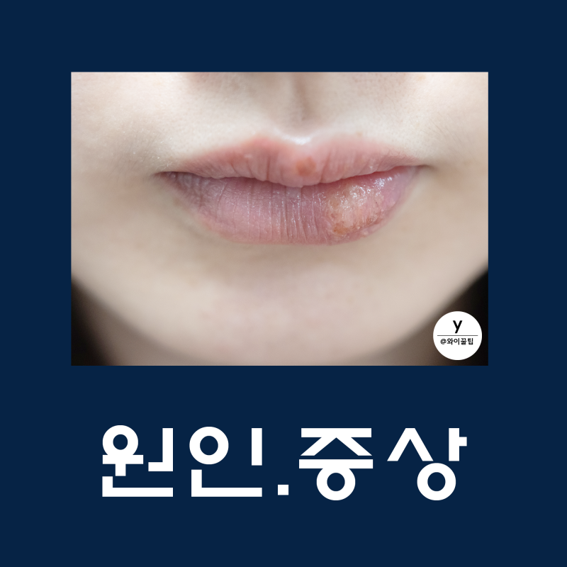 입술 헤르페스 입술포진 구순포진 원인 증상 약 치료 전염 수포 물집 네이버 블로그