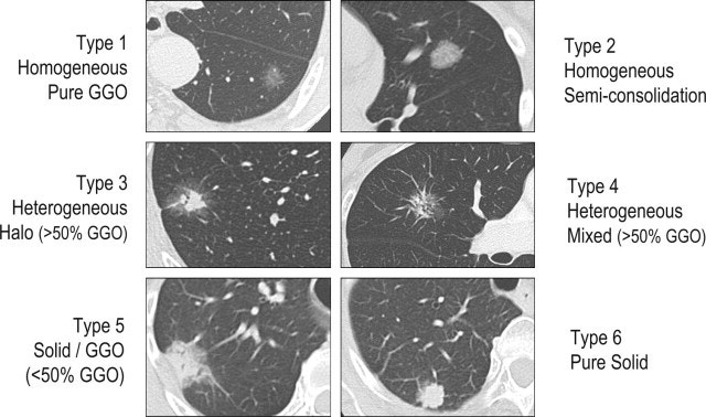 간유리음영 폐결절(Overview of Pulmonary nodules with ground-glass opacity ...