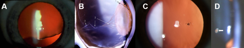 [EYE잘보여] 수정체의 선천이상 - 무수정체증, 원추수정체, 구형수정체, 수정체 결손증, 미텐도르프점, Epicapsular ...