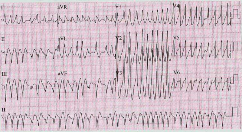 INTERNAL MEDICINE Q. 0013 [Atrial fibrillation with WPW] : 네이버 블로그