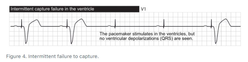 014. 신규간호사를 위한 pacemaker의 모든 것 : 네이버 블로그