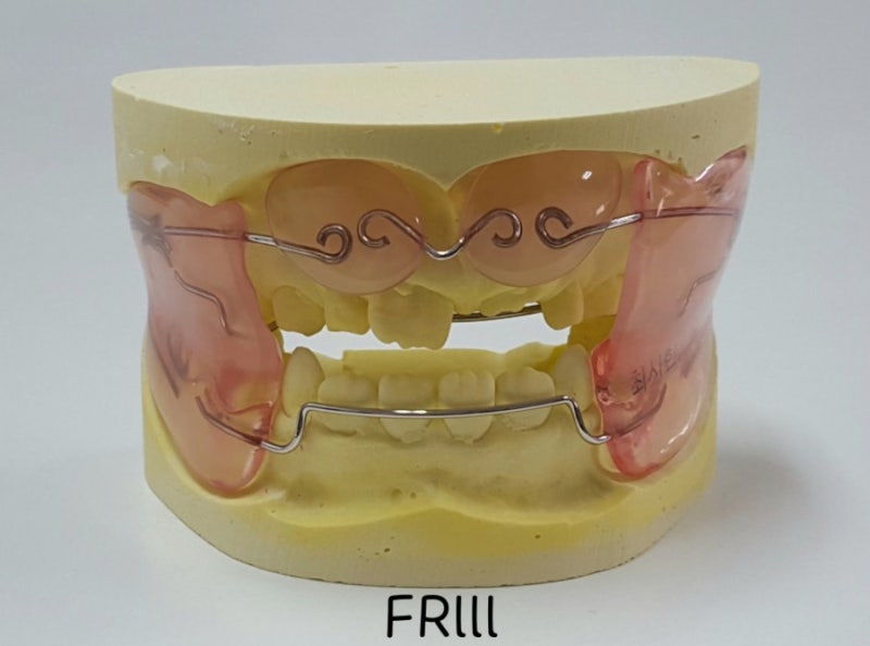 Frankel appliance/Function Regulator : 네이버 블로그