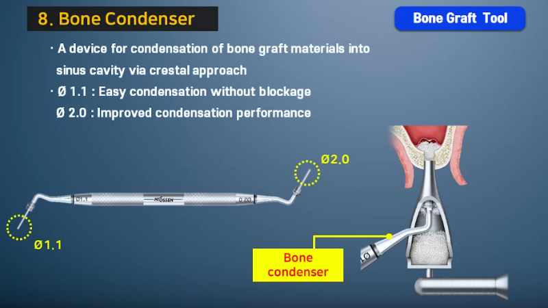 [백은준 수석원장님 칼럼] CAS KIT를 이용한 상악동 거상술 : 네이버 블로그