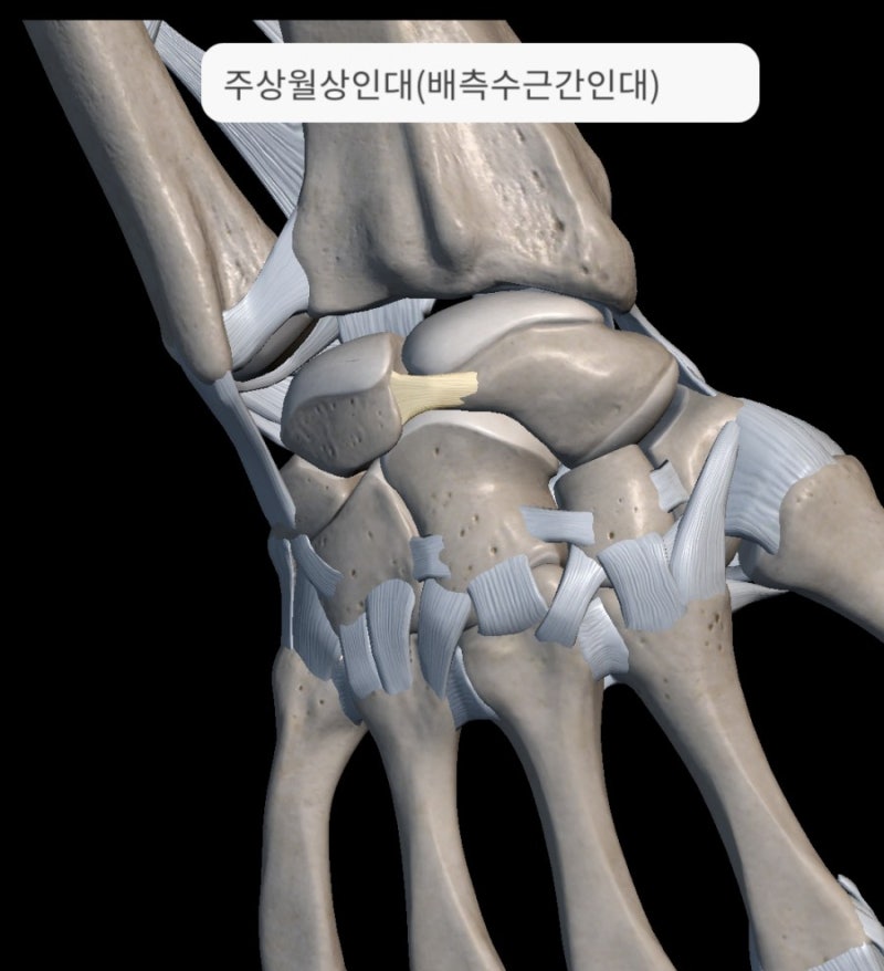 손목통증, 손목외측통증(Radial-Sided Wrist Pain), 주상골 인대손상(Scapholunate Ligament ...